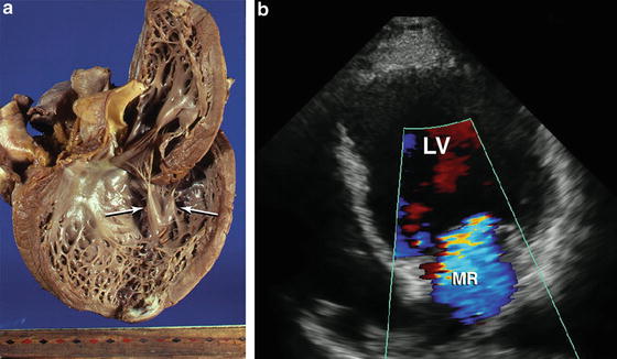 Pathology Of Ischemic Heart Disease Thoracic Key pathology-of-ischemic-heart-disease-thoracic-key