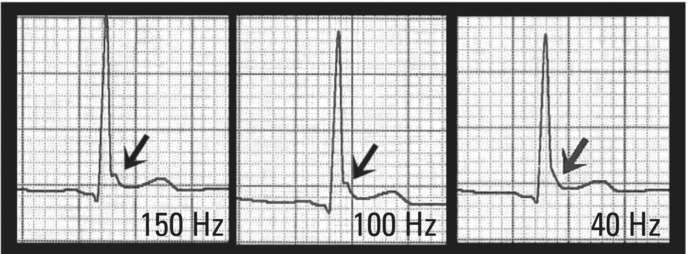 The ECG Recording: Leads, Devices, and Techniques | Thoracic Key