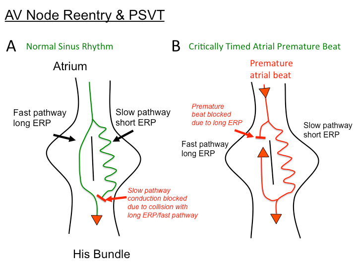 Cellular Basis of Arrhythmias | medicalrojak