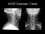 Anterior Cervical Discectomy Fusion Todd Jackman Minnesota Spine