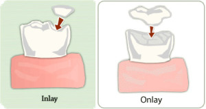 Partial Dental Crowns NYC | Inlays & Onlays Tribeca