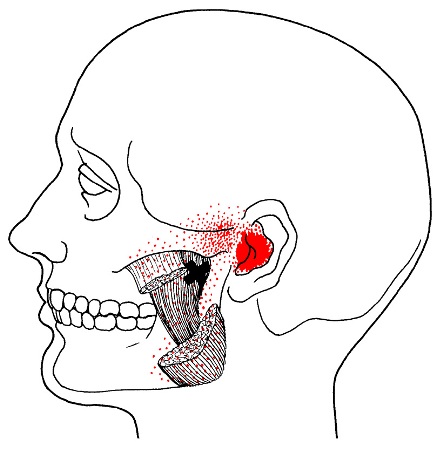 Masseter Trigger Points and Referred Pain Patterns ...