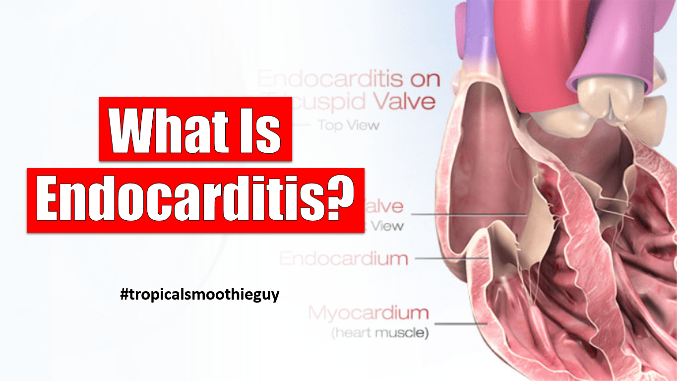 What Is Endocarditis what-is-endocarditis