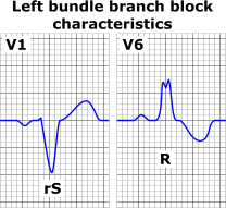 ECG bundle branch block | Medical Mnemonics