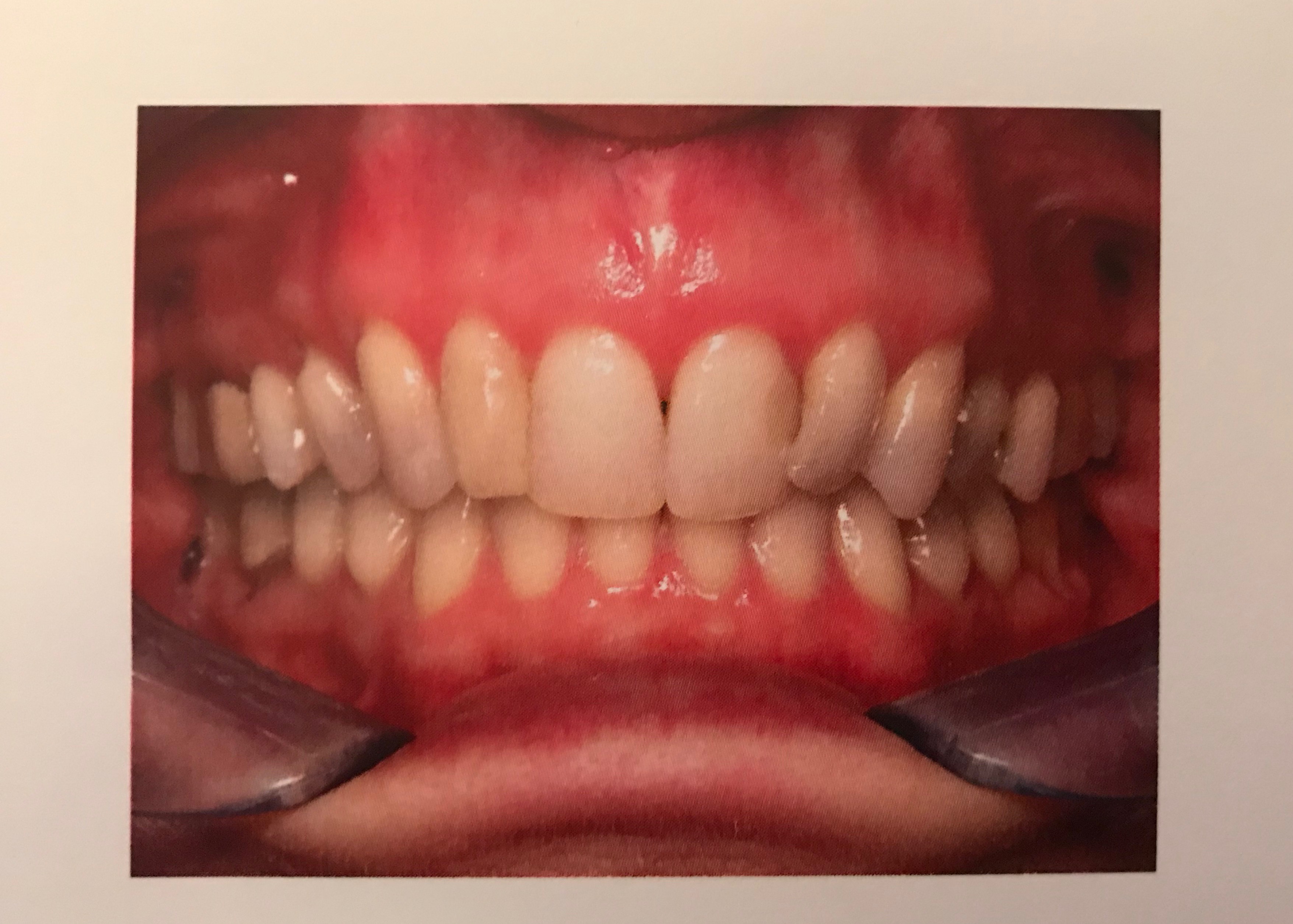 Invisalign: The End of The Journey – THE WIDOW BADASS BLOG