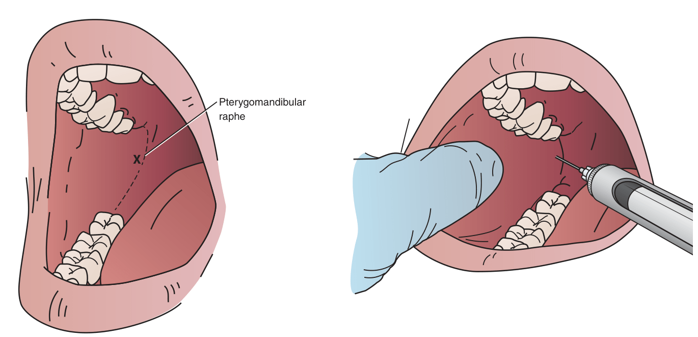 Pterygomandibular Raphe Pterygomandibular Raphe