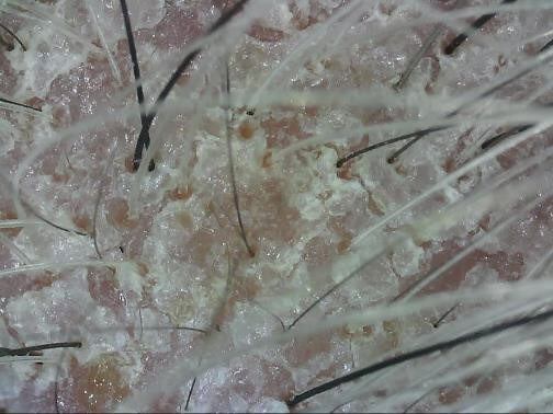 Dermatitis: Causes, Treatment & Prevention | AROMASE