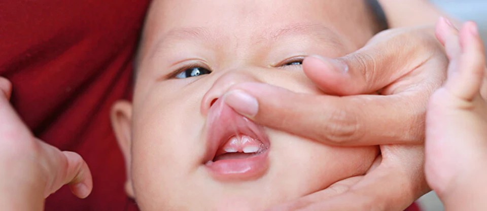What Is Lip Tie What To Do If Your Baby Has It Babocush Limited