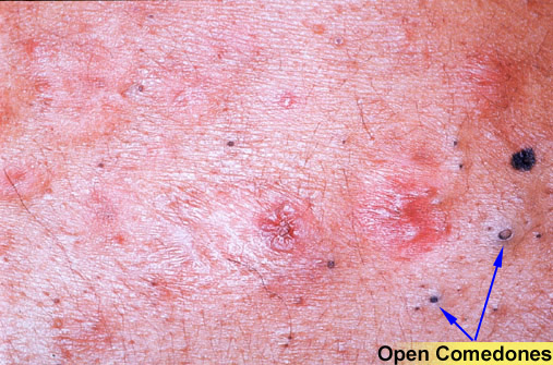 Acne Vulgaris – RN Nursing Notes