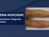 Erythema Nodosum Causes Symptoms Diagnosis Treatment