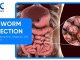 Pinworm Infection Causes Symptoms Diagnosis And Treatment
