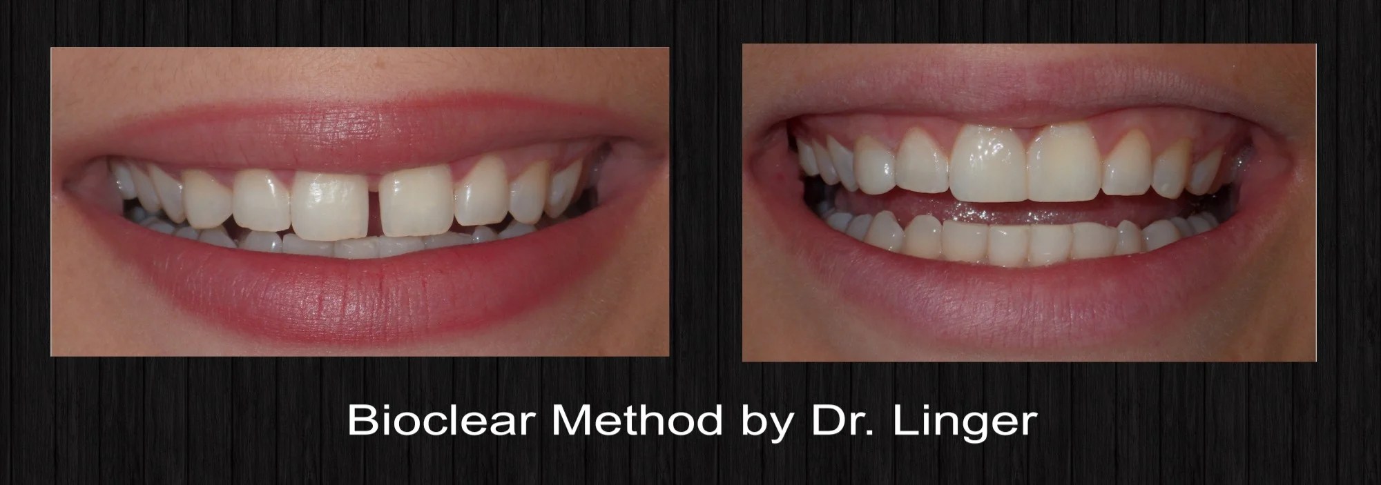 Bioclear Dental Bonding Charlotte Nc William Linger Dds Magd