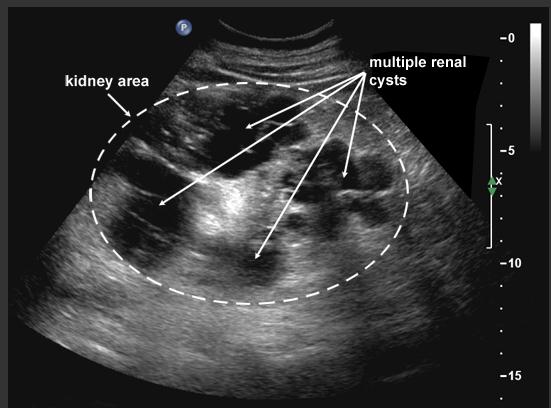 Nephrolithiasis: Diagnosis and Management in the ED - emdocs