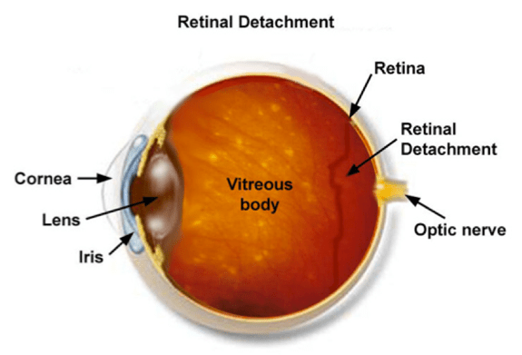 Ultrasound for Retinal Detachment - emdocs