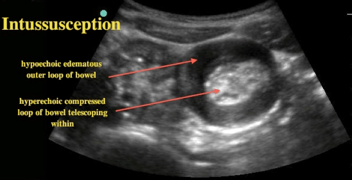 Intussusception