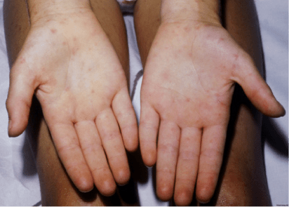 emDOCs.net – Emergency Medicine EducationDiagnosis and Treatment of ...