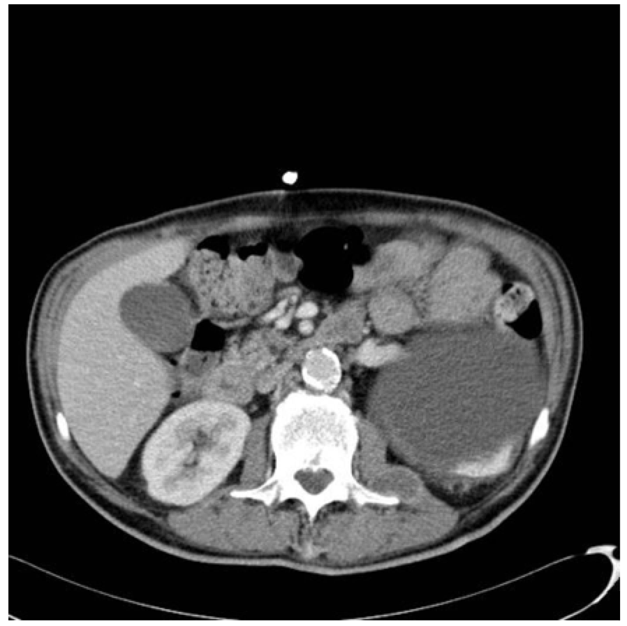 Psoas Sign Radiology
