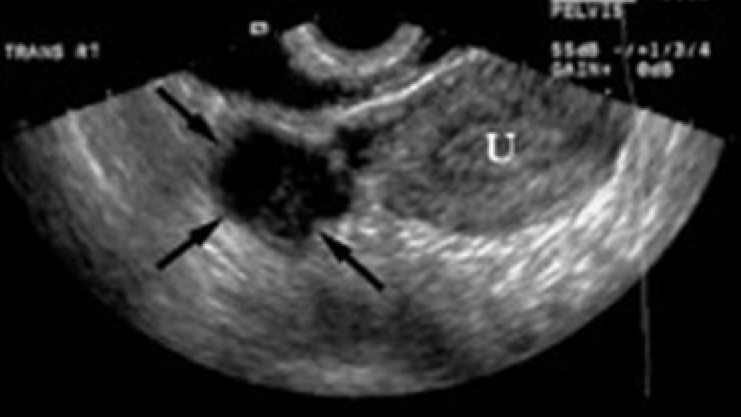 Tubo-ovarian Abscess: Pearls & Pitfalls - emdocs