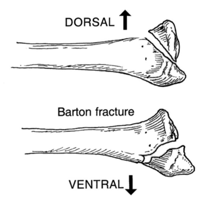 Bartons Fracture