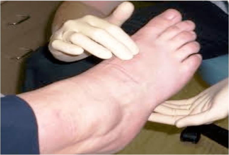 emDOCs.net – Emergency Medicine EducationPopliteal Artery Injury from ...