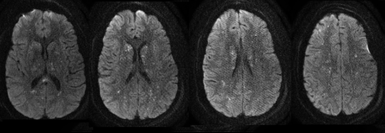 fat embolism syndrome Archives - emdocs