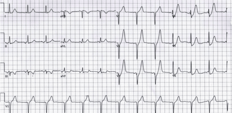emDOCs.net – Emergency Medicine EducationAtypical STEMI Patterns and ...