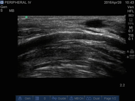 Ultrasound-Guided Peripheral Intravenous Access - Tips for Success - emdocs