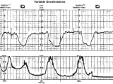 Variable Decelerations Explained