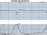 Variable Decelerations Explained