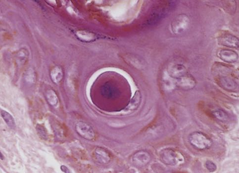 Does pyknosis occur in necrosis or apoptosis? | Pathology Student