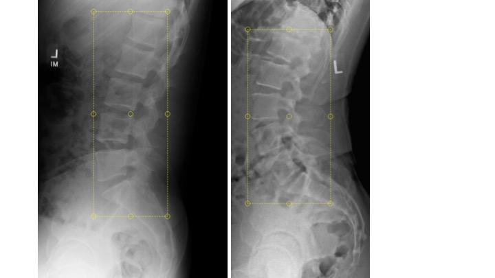 Lateral Lumbar Digitization – Computer Vision CBP Technique ...