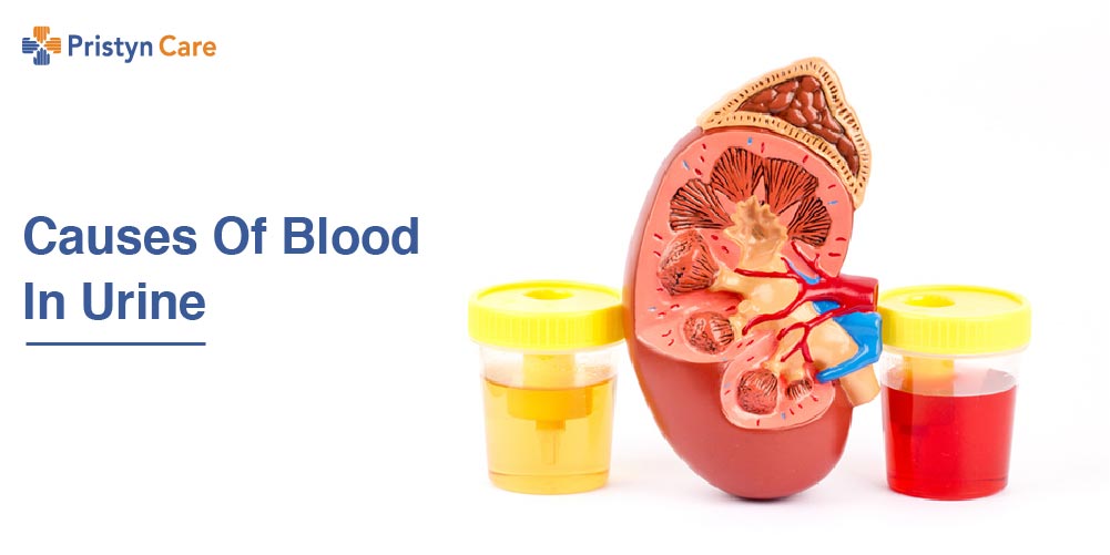 What Could Blood In Your Urine Mean Prnso what-could-blood-in-your-urine-mean-prnso