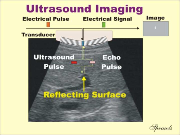 Ultrasound Mediated Bio-effects And Sonoporation. – GURUKOOL śloka