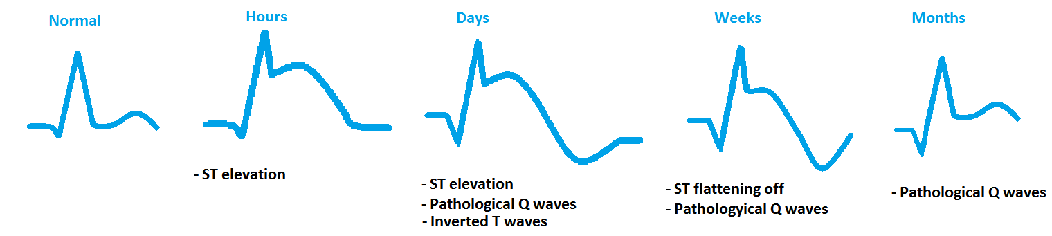 Electrocardiogram Guide (EKG/ECG) – Stepwards