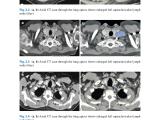 Solution Chest Lymph Node Anatomy Studypool