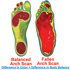 Symptoms Of Falling Arches