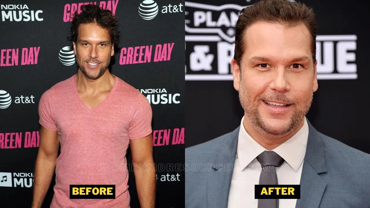 Dane Cook Plastic Surgery. What Happened To Him And His Face?