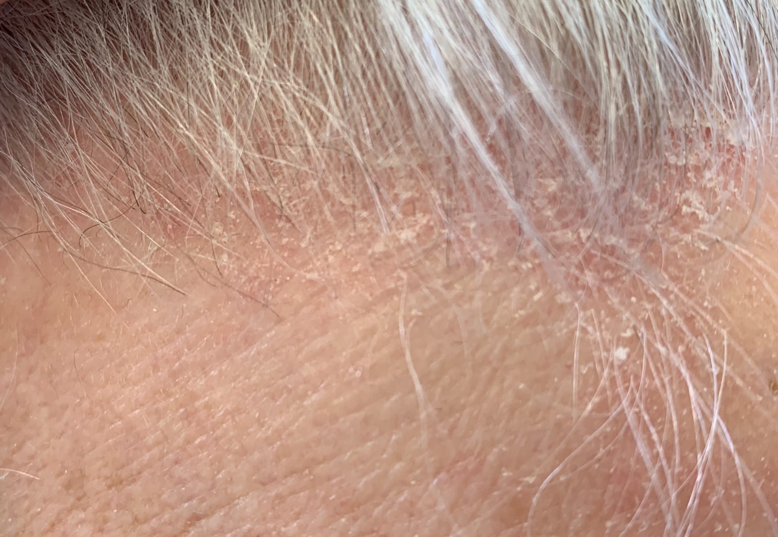 Seborrhoeic Dermatitis Chest