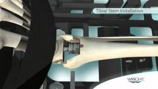 INBONE Total Ankle Replacement