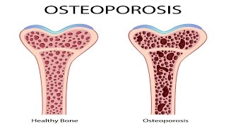 OSTEOPOROSIS: Causes, Diagnosis, Treatment and Prevention, Gary Kraus MD Back and Neck Houston, TX