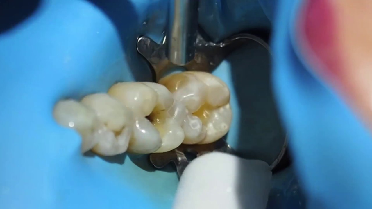 Posterior Composite Resin Restoration Dr Lincoln Harris Youtube